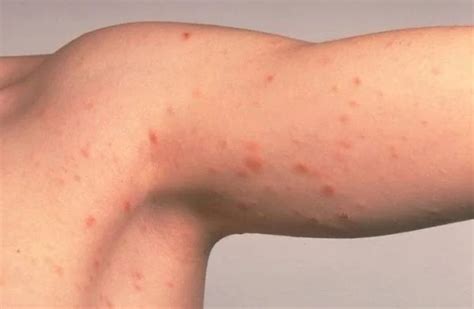 بیش از 15 علت دانه های قرمز بدون خارش روی پوست