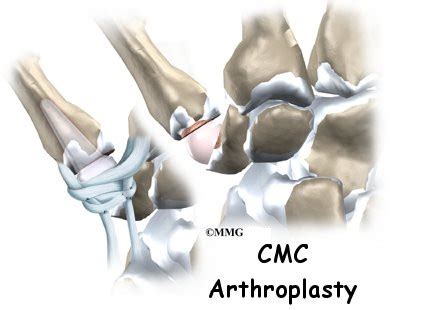Artificial Joint Replacement Of The Thumb Orthogate