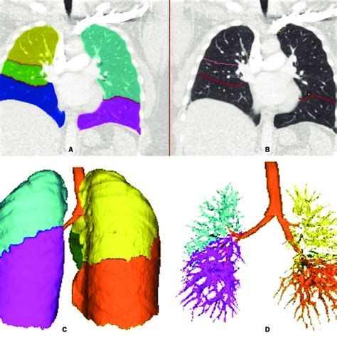 Illustrative Reconstructions Of The Automated Pulmonary Segmentation Download Scientific