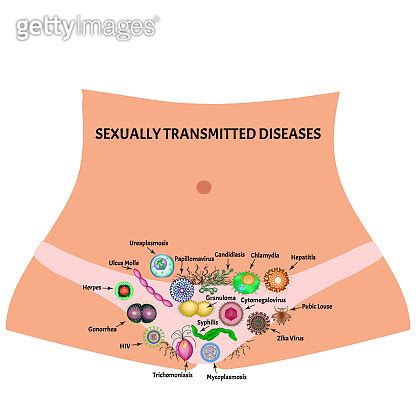 Viral And Bacterial Infections Sexually Transmitted Diseases Infographics Vector Illustration