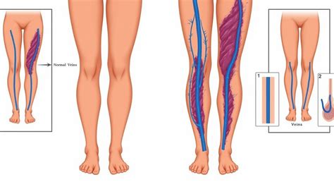 ბუნებრივი მეთოდი ვენების ვარიკოზული გაგანიერების დასამარცხებლად რჩევები ვივიენისგან