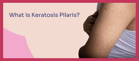 The Science Of Keratosis Pilaris Chicken Skin Skin Type Solutions