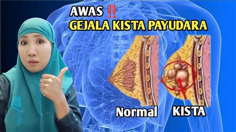 Benjolan Di Payudara Dan Nyeri ‼️gejala Kista Payudara Yg Harus Di