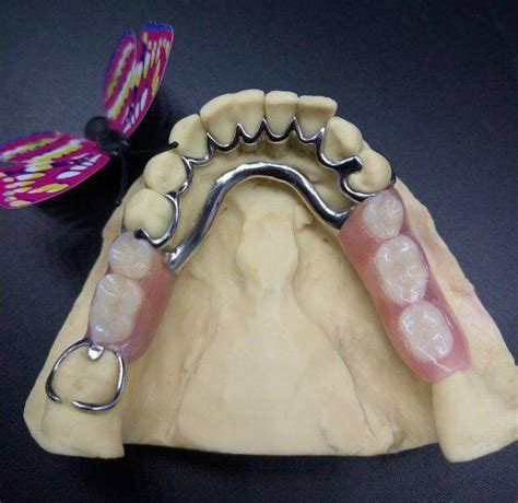 Cast Framework Add Valplastflexible Denturesremovable Partial Denture