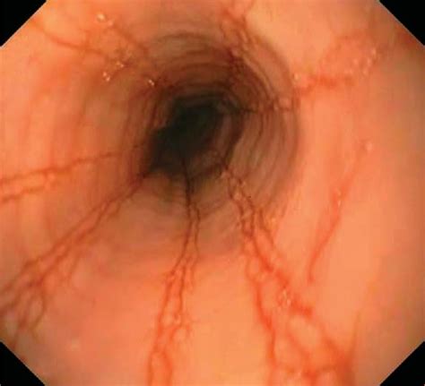 Longitudinal Furrows In Oesophageal Mucosa Download Scientific Diagram
