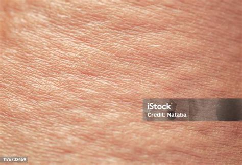 화상과 알레르기로 인한 주름 머리카락 및 물집으로 덮인 인간의 분홍색 자극받은 피부의 질감의 측면 보기 가리기에 대한 스톡 사진