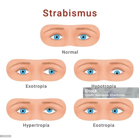 Strabismus Eyes Types Normal Hypotropia Hypertropia Exotropia Esotropia