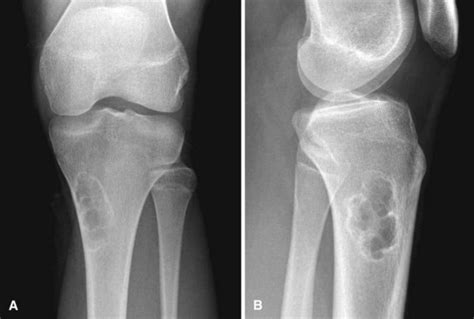 Benign Bone Tumors And Nonneoplastic Conditions Simulating Bone Tumors Musculoskeletal Key