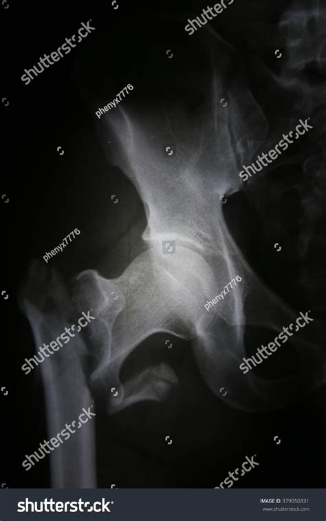 Xray Photos Bone Fracture Patients Stock Photo Edit Now 379050331