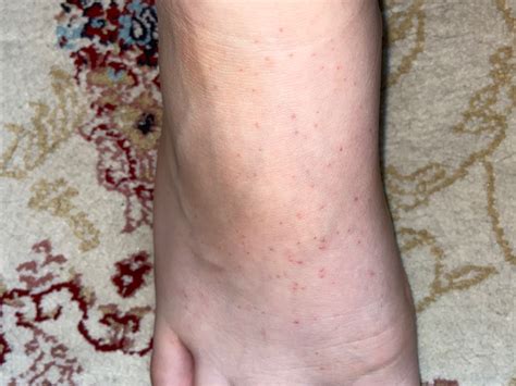 Красные точки на стопе Вопрос дерматологу 03 Онлайн