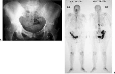 Metastatic Disease TeachMe Orthopedics