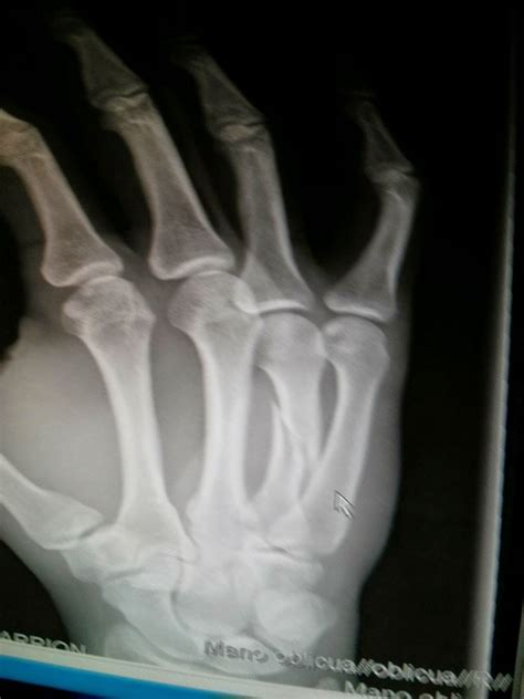 Chemi Ch Breaking Hand Fractura 4°metacarpiano El Comienzo