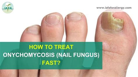 How To Treat Onychomycosis Nail Fungus Fast