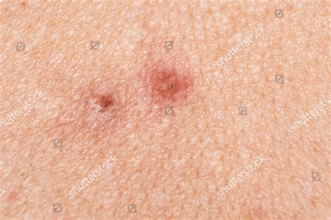 Teenage Skin With Acne Problems Two Manually Broken Pimples That Formed The Crust With Risk Of