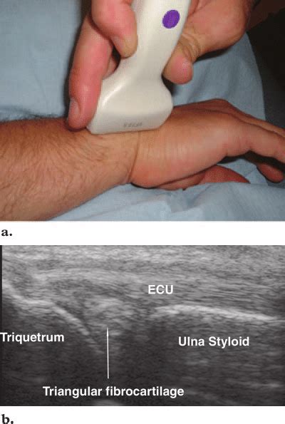Sonographic Examination Of The Ulnar Surface Of The Wrist A