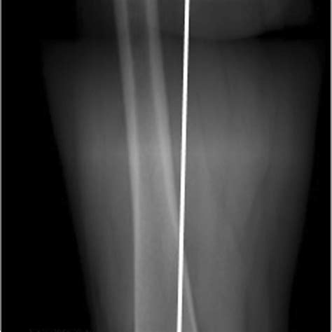 The Lateral Distal Femur Angle Ldfa Is Measured On The Whole Leg