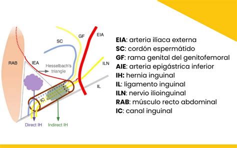 Hernia Inguinal Directa Y Ecografía Tempo Formación