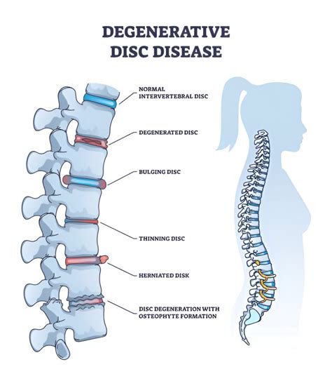 Degenerative Disc Disease In The Neck C5 6 And C6 7 Symptoms And Surgical Treatment Kings