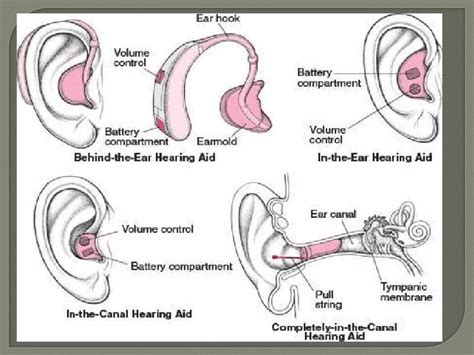 Cochlear Implant Pptx