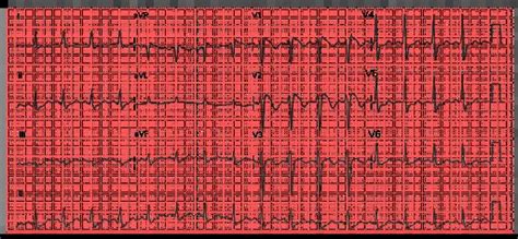 High Yield Neet Ss Medicine Cardiovascular Questions
