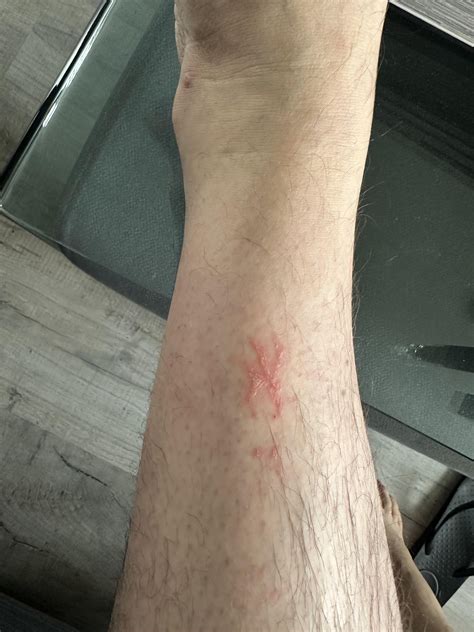 Leg Rash R Diagnoseme