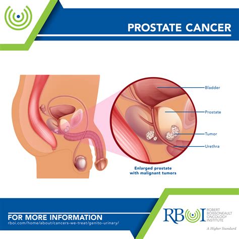 Prostate Cancer Symptoms