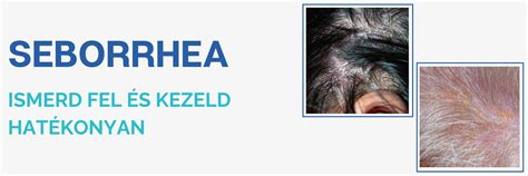Seborrhea Kezelése Oxygeni Hair And Skin Hajgyógyászati és Kozmetikai