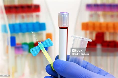혈액학 실험실에서 분석을 위해 환자의 혈액 샘플이있는 카테터 와 튜브 혈액검사에 대한 스톡 사진 및 기타 이미지 혈액검사 도뇨관 헌혈 Istock