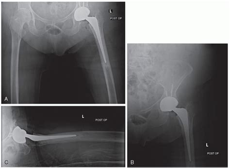 Cemented Stems Musculoskeletal Key