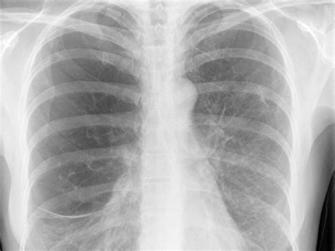 healthy lungs vs smokers lungs x ray