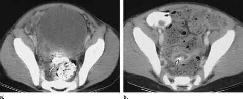 Recurrent Abscess In A 6 Year Old Female Patient With Appendicolith