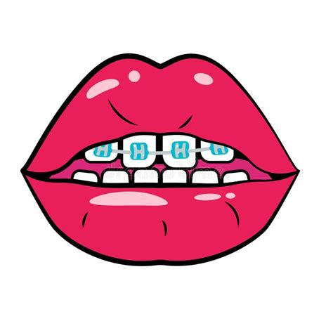 Red Open Mouth With Braces On Teeth Stock Illustration Illustration