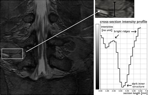 2010 winter project week spine segmentation module in slicer3 namic wiki