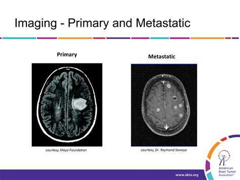 Brain Tumor Using Artificial Intelligence Ppt