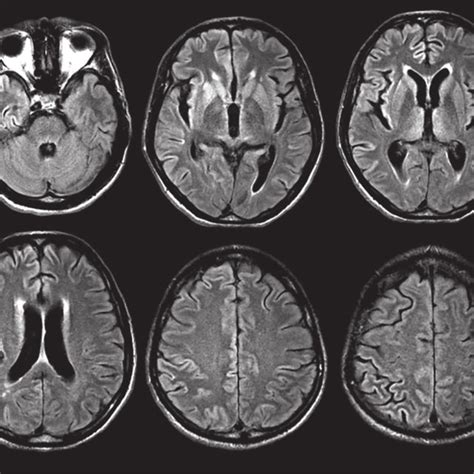 Diffusion Weighted Imaging Dwi Bilateral Restricted Diffusion