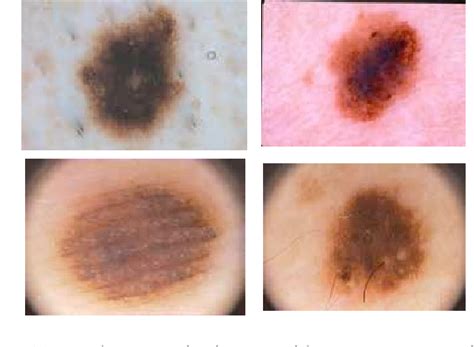 Figure 1 From Supervised Classification Of Dermoscopic Images Using Optimized Fuzzy Clustering