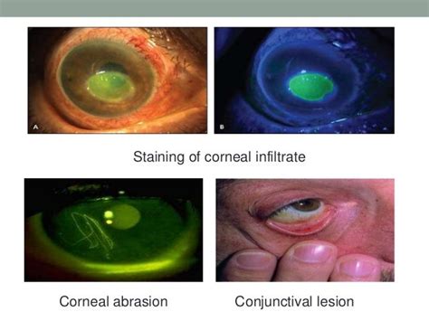 Corneal Staining Procedure