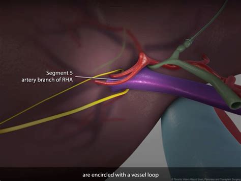 Tvasurg Process 3d Animation Tvasurg The Toronto Video Atlas Of Surgery