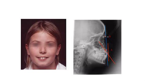 Cephalometrics Analysis Pptx