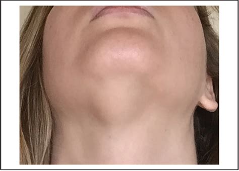 Figure 1 From Plunging Ranula A Case Report Semantic Scholar