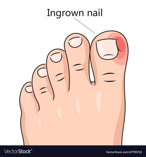 Onychocryptosis Kerassentials Toenail Fungus Treatment Oil