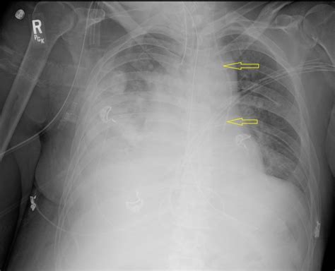 Right Site Wrong Route ― Cannulating The Left Internal Jugular Vein Pmc