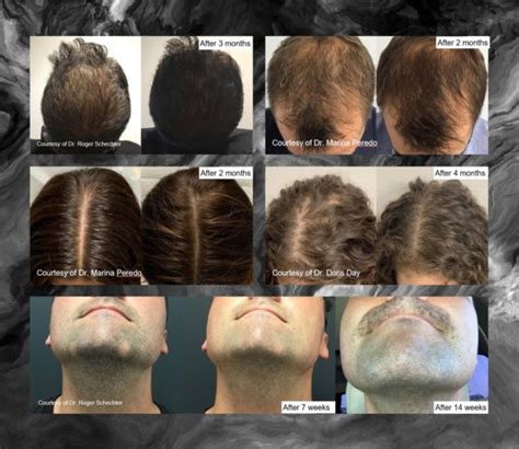 Exosome Facial In Prosper Tx Lotus Med Spa