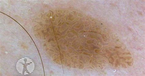 Dermoscopy Image