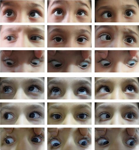 Duane Syndrome Of The Left Eye Upper Panel Before Surgery In The Left