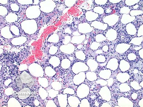 Subcutaneous Panniculitis Like T Cell Lymphoma Pathology