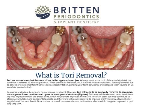 What Is Tori Removal Britten Perio