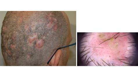 Scalp Disorders In Dark Phototypes