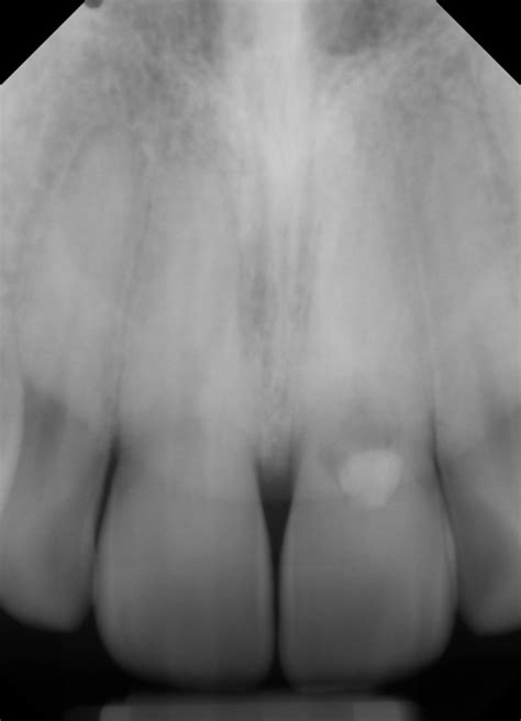 Tooth Root Resorption Archives Deborah Gennero Dds Aaacd Fagd