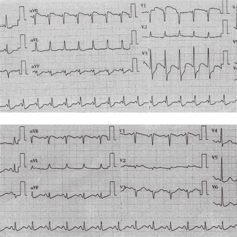 Ecg In Case 1 Fig 1a Initial Electrocardiogram Showing St Elevation Download Scientific